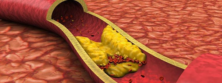 Blood lipids a risk for cardiovascular - LifeServ'